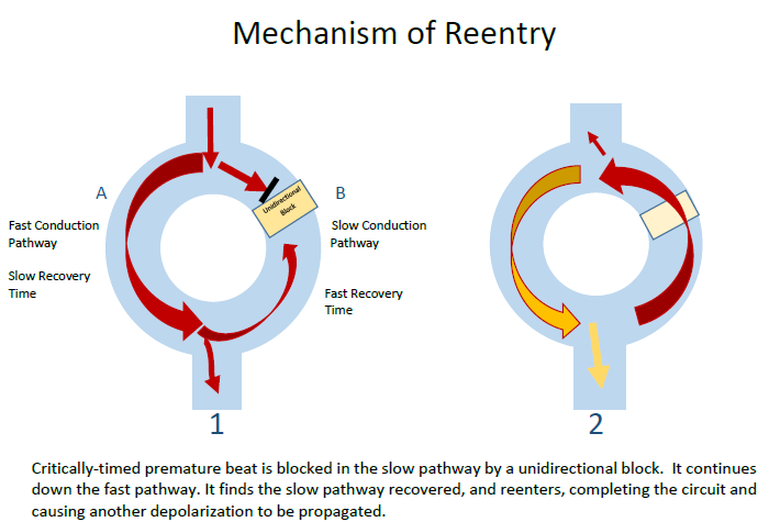 Reentry | ECG Guru - Instructor Resources Reentry | ECG Guru - Instructor Resources